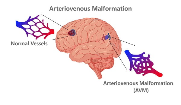 Arteriovenous Malformation Avm | تشوه شرياني وريدي – Yashfiin Health ...